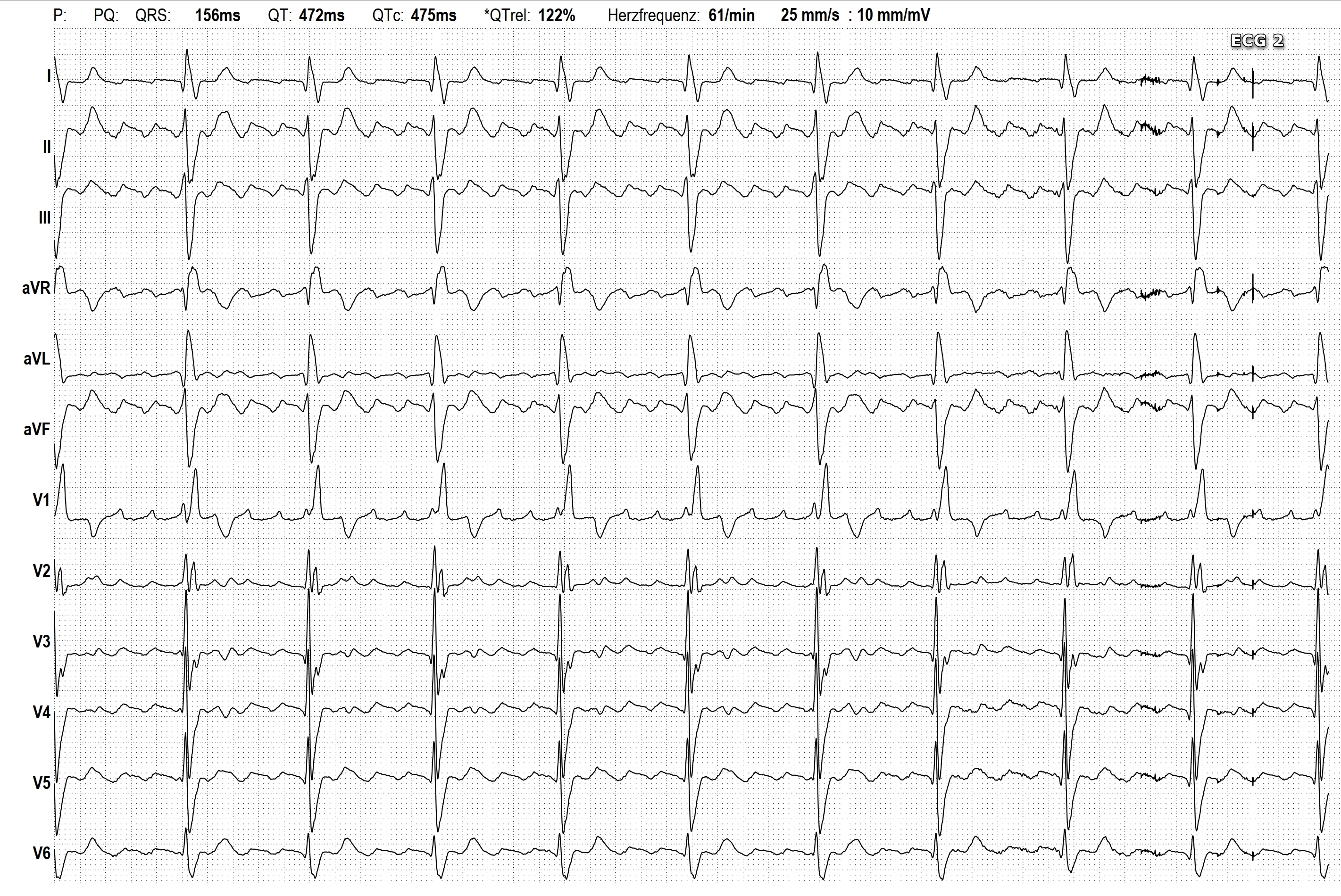 Atypical Atrial Flutter | ECG Guru - Instructor Resources